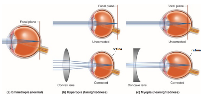 A person is wearing spectacles with concave lenses for correcting ...