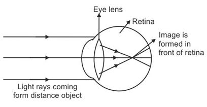 Myopia can be corrected by _____A. Converging lensB. Bifocal lensC ...