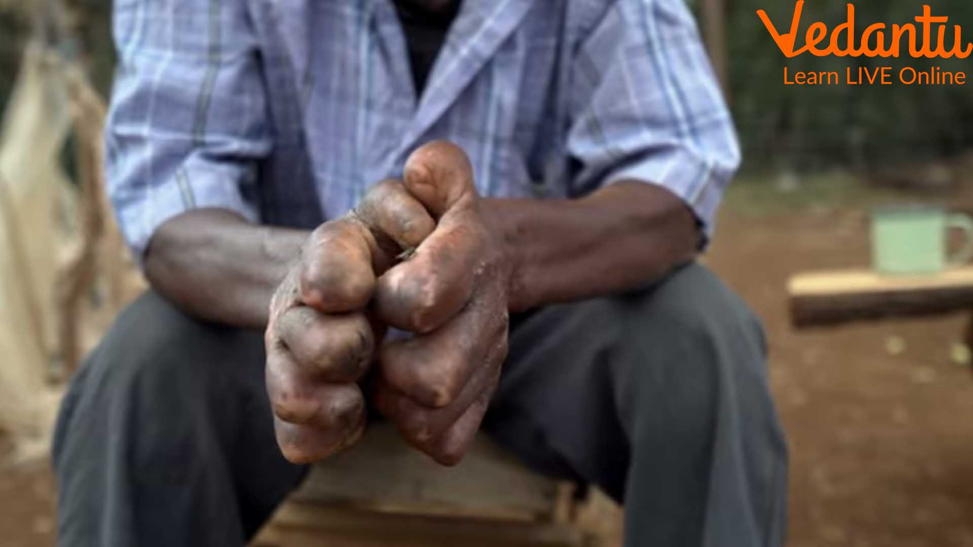 Global Impact: World Leprosy Day Eradication Efforts